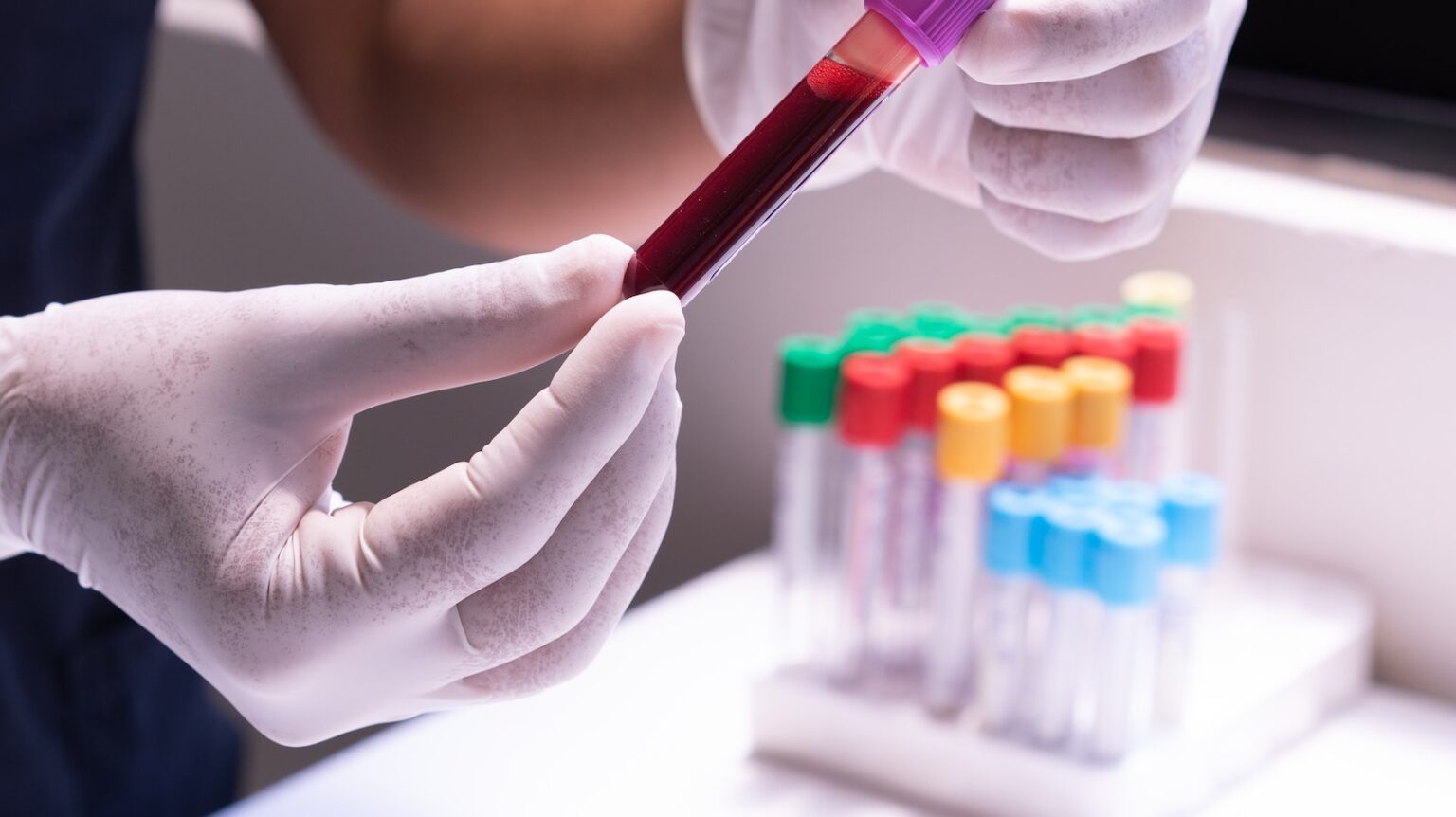 Measuring Blood Volume: How Many ml in a Unit of Blood - JustALittleBite